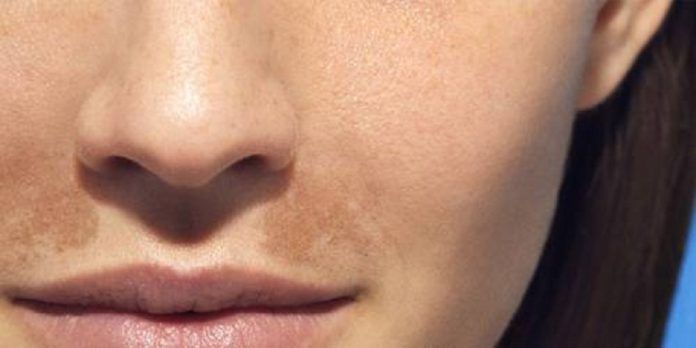 Macchia scura dei baffetti, eliminala in questo modo senza make up