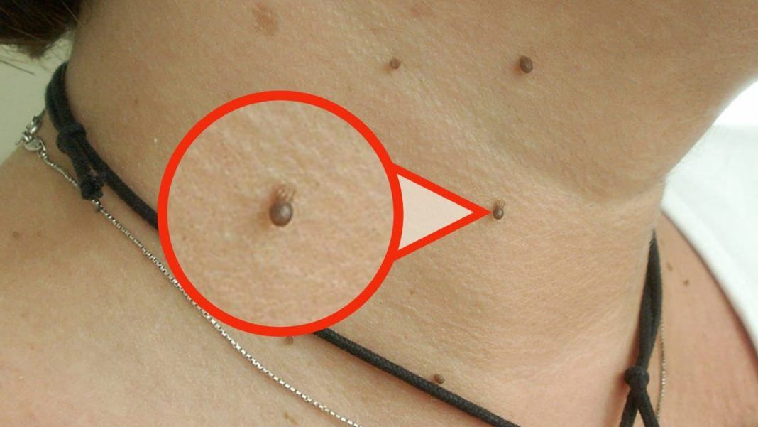 Fibromi penduli sul collo, come eliminarli in maniera naturale
