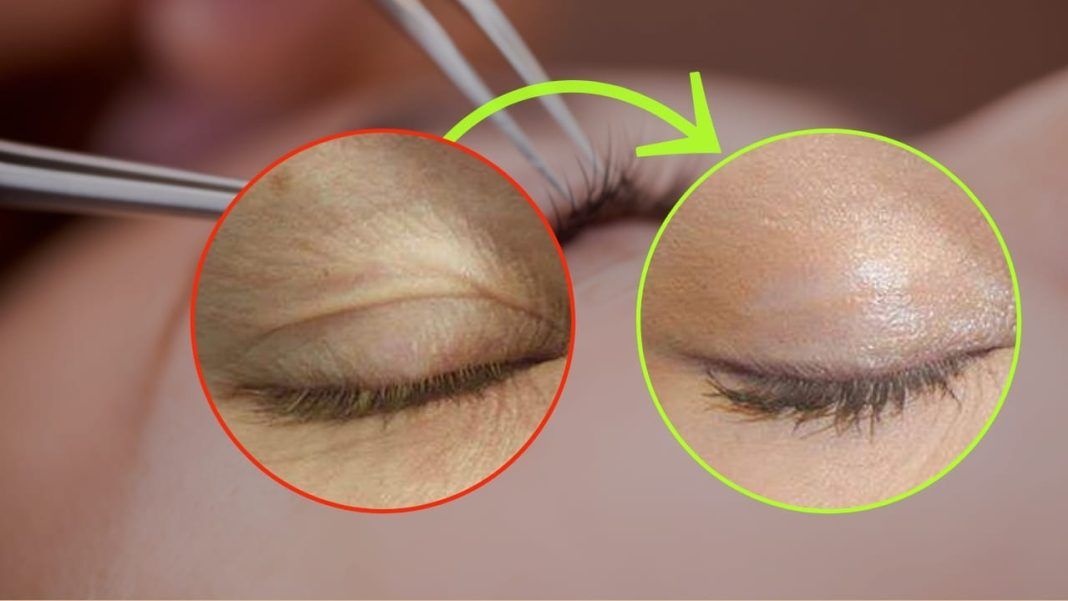 Palpebra cadente, risolvi con l'antico rimedio della nonna: funziona ...